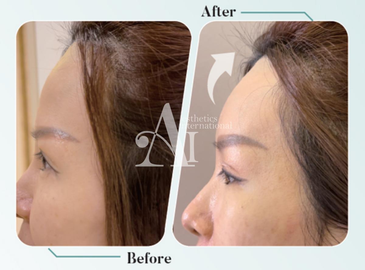 Forehead Filler | Radiesse Advanced Dermal Filler | Aesthetics ...