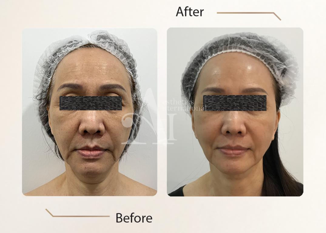 Time Freeze Laser Lift | V Shaped Lifting Instantly | Aesthetics ...